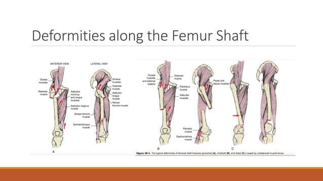 Femoral Shaft fracture | PPT | Free Download
