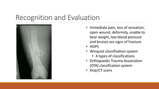 Femoral Shaft fracture | PPTX