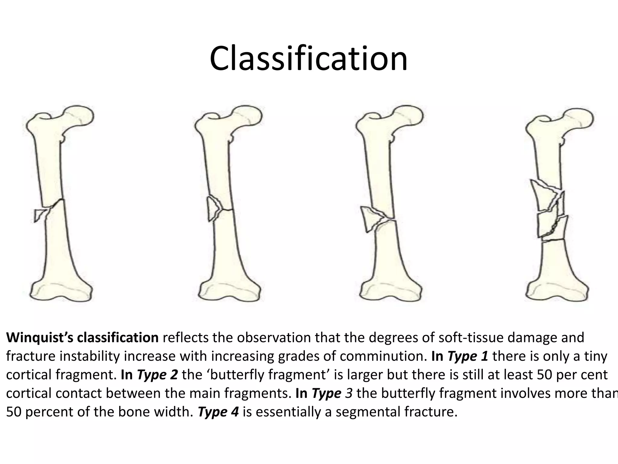 Femoral fracture | PPTX