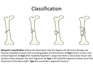 Femoral fracture | PPTX