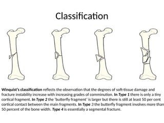 Femoral fracture (Anees).pptx traumatology | PPTX
