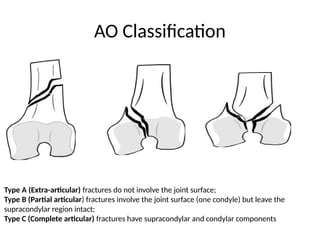 Femoral fracture (Anees).pptx traumatology | PPTX