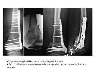 Femoral fracture (Anees).pptx traumatology | PPTX