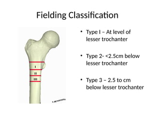 Femoral fracture (Anees).pptx traumatology | PPTX
