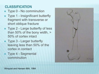 Accidental Femoral fractures | PPT