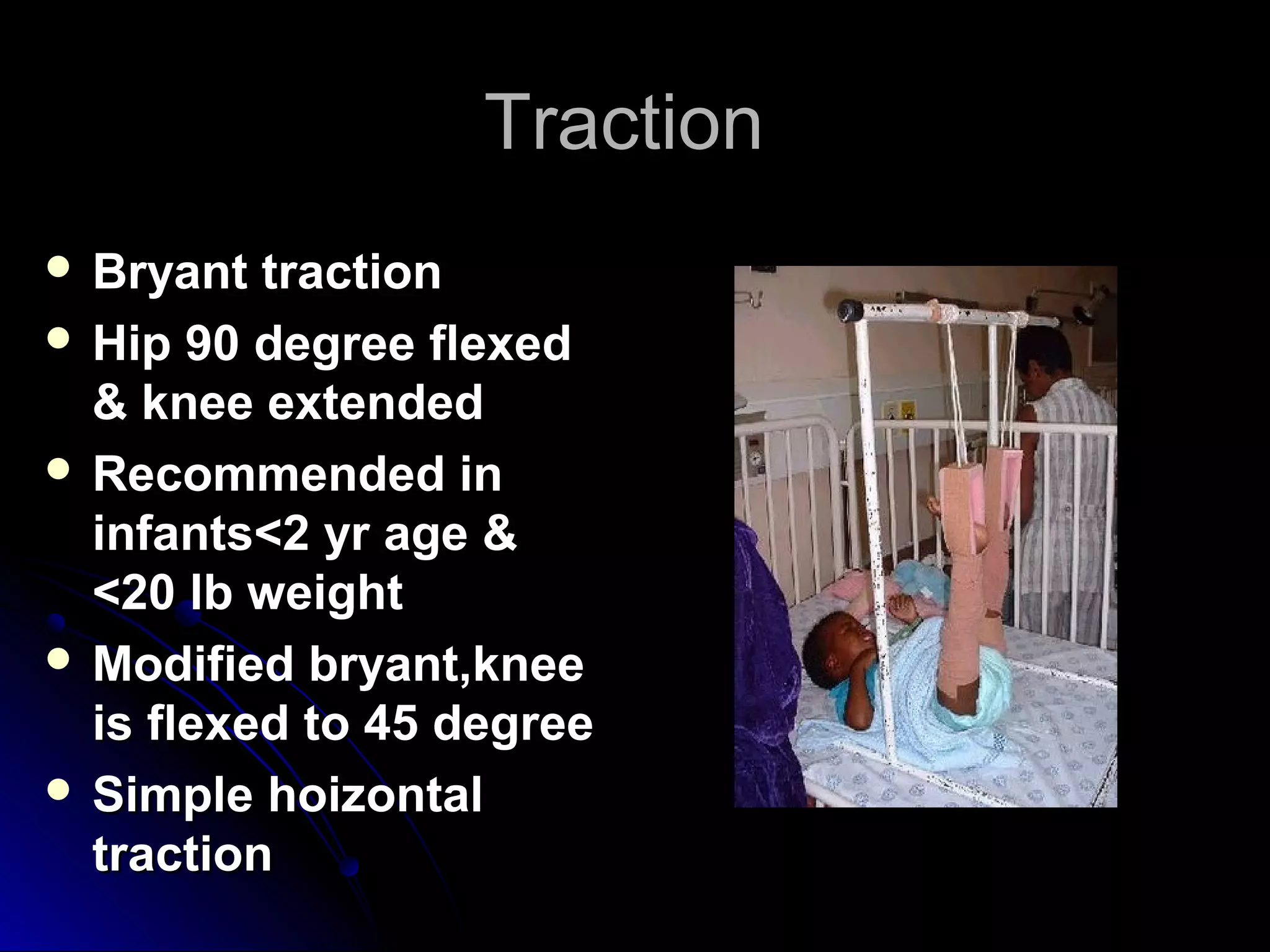 Femoral fractures in children | PPT