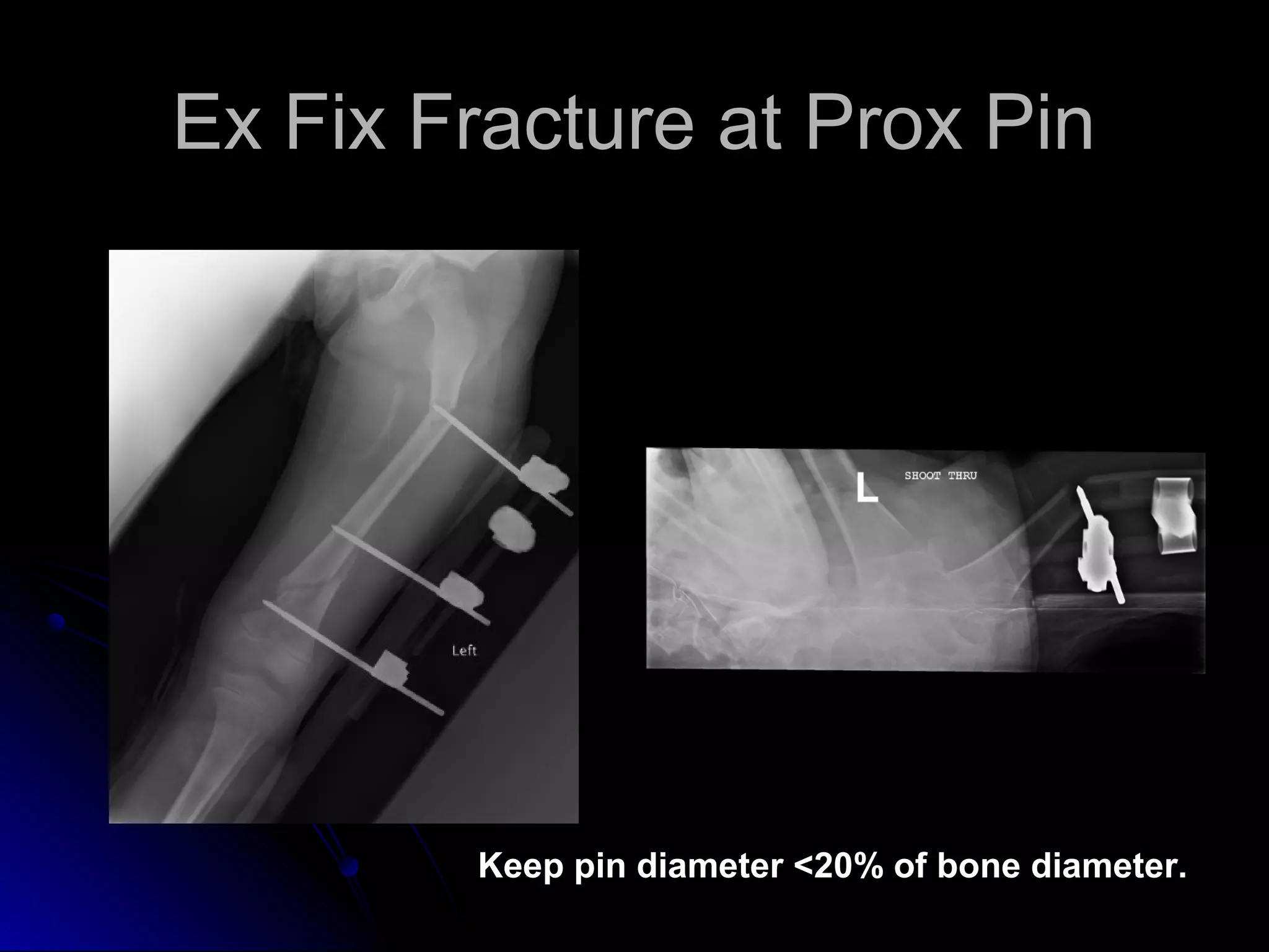 Femoral fractures in children | PPT