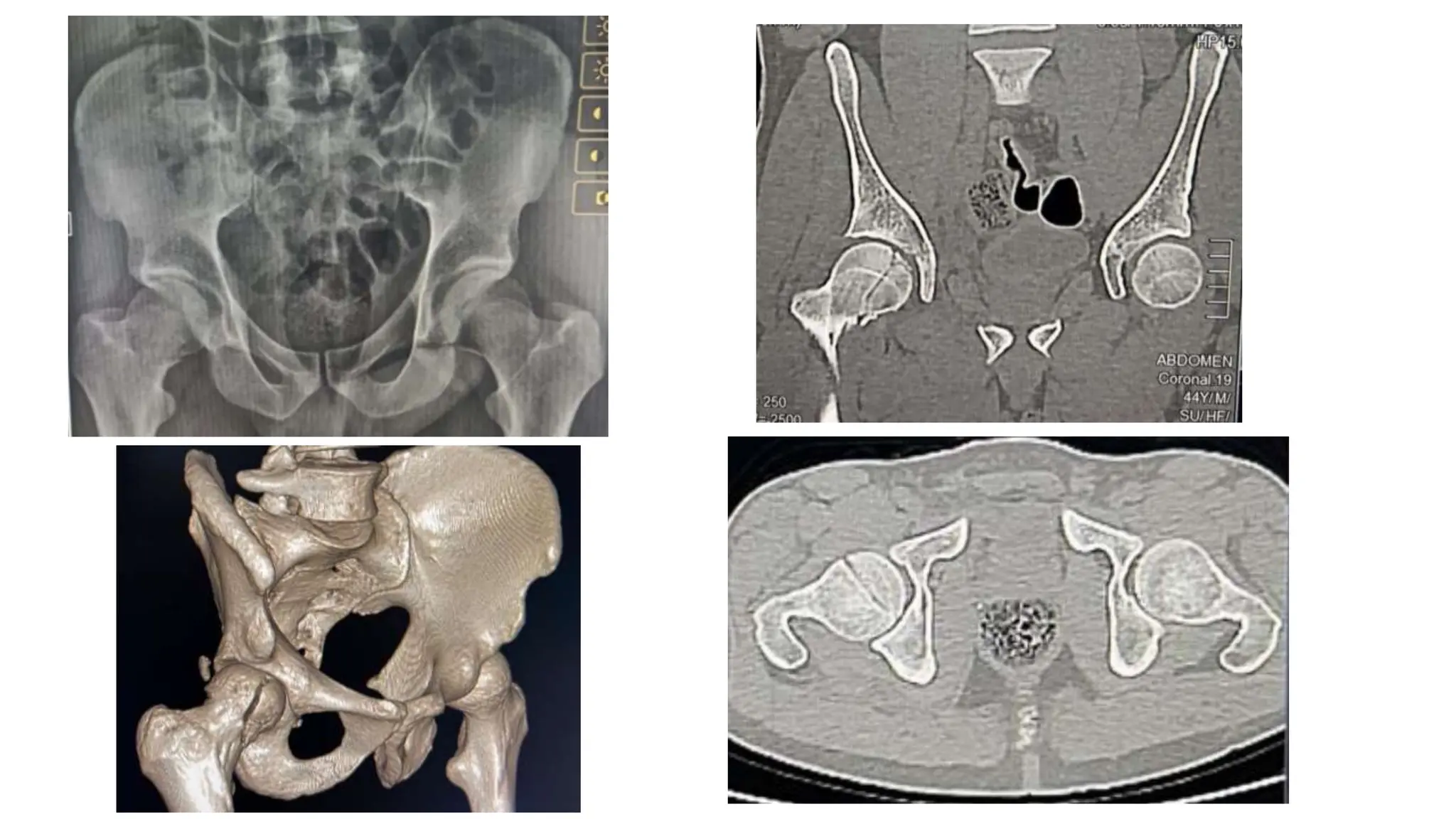 safe surgical dislocation for treatment of femoral head fracture.pptx