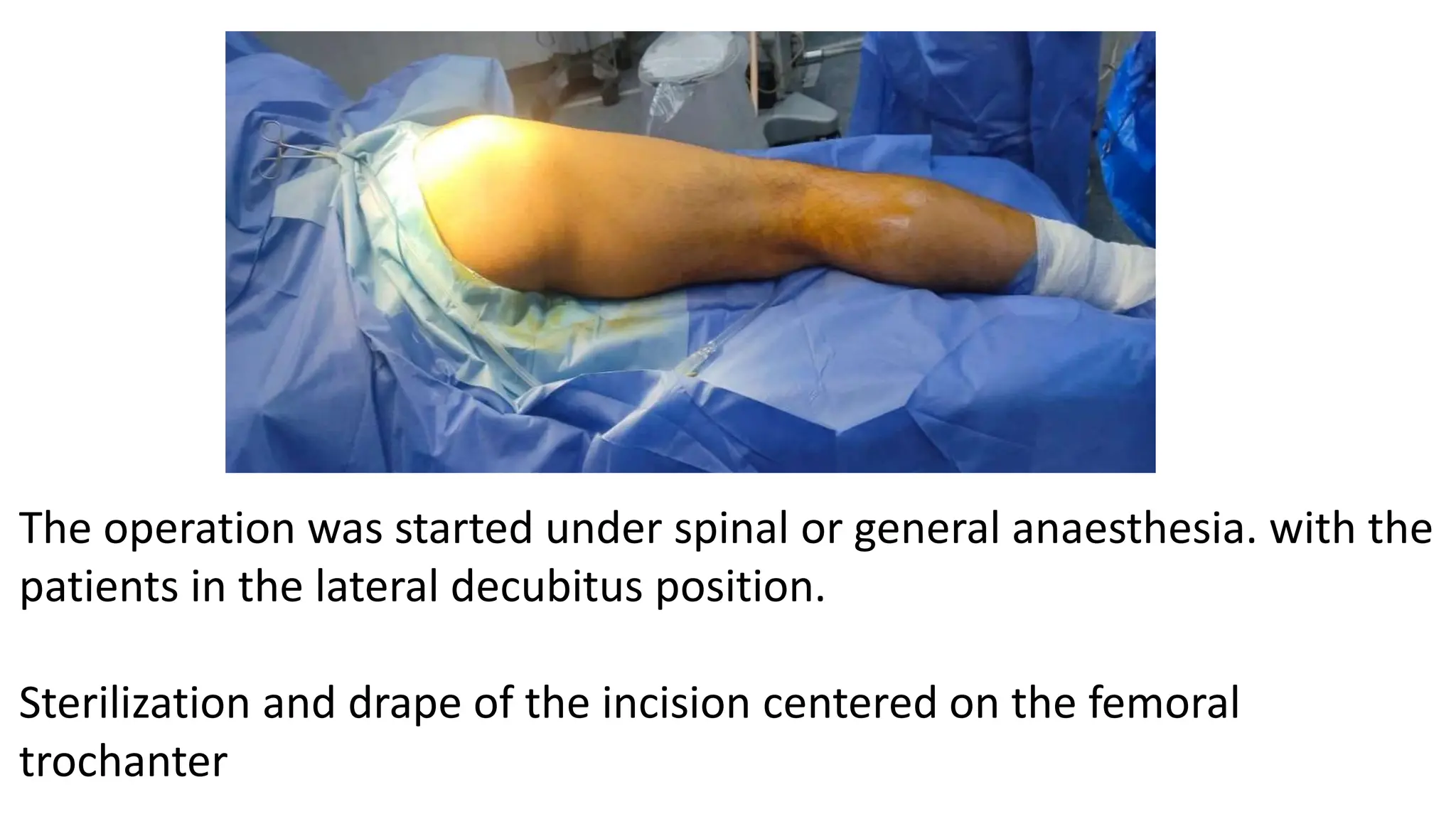 safe surgical dislocation for treatment of femoral head fracture.pptx