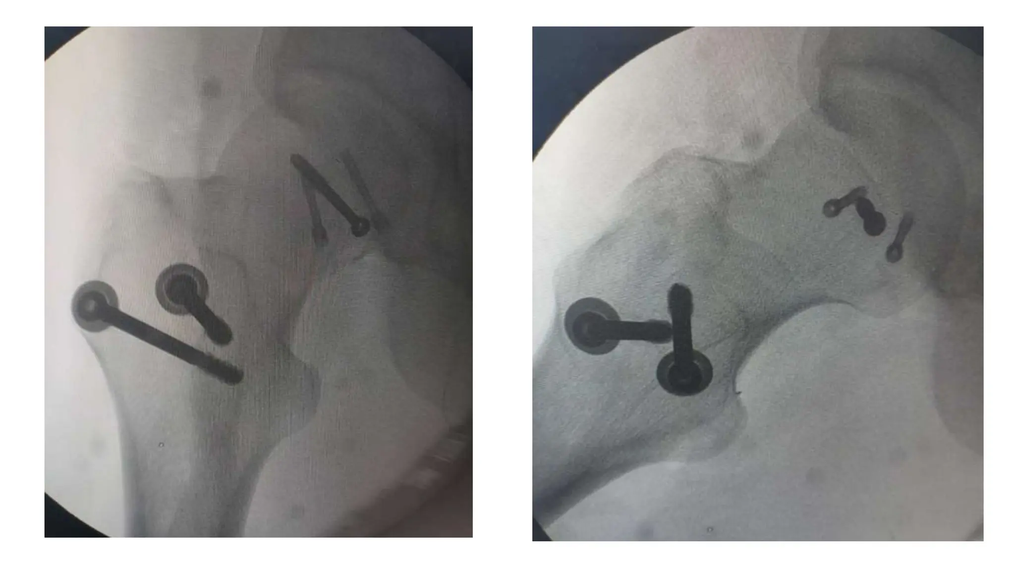 safe surgical dislocation for treatment of femoral head fracture.pptx