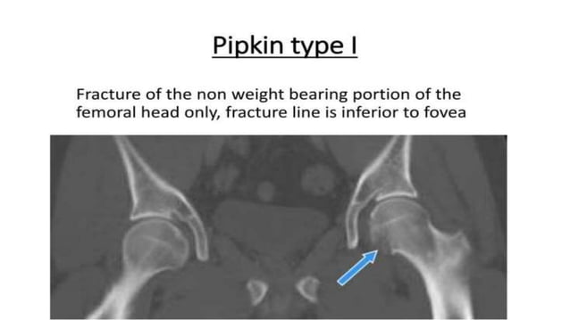 safe surgical dislocation for treatment of femoral head fracture.pptx