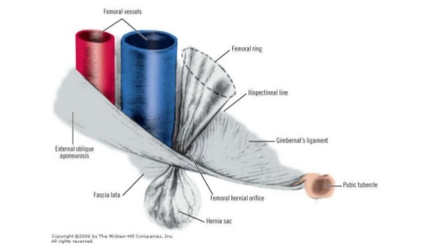 Femoral Ring Hernia