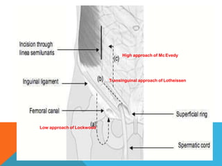 Femoral hernia | PPTX