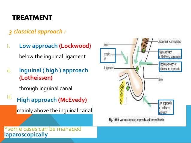 Femoral hernia