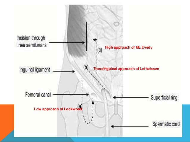 Femoral Ring Hernia