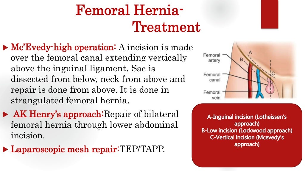 Femoral Hernia Symptoms Men Hernias And Groin Swellings Most Porn Sex