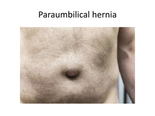 Femoral hernia lec to 1st year | PPTX