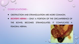 FEMORAL HERNIA BY Dr A . SAKTHI THANGAVEL.pptx