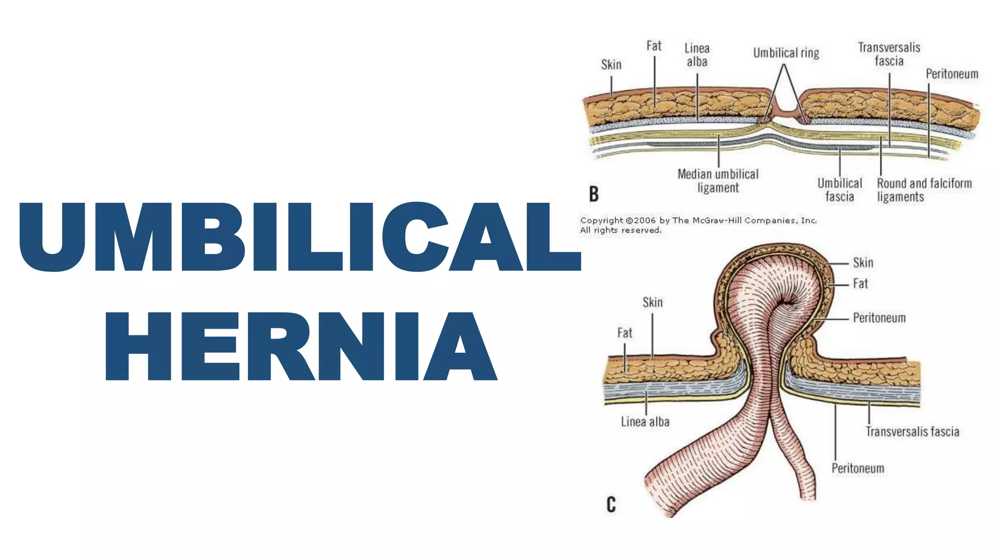 Femoral hernia with umbilical hernia | PPTX