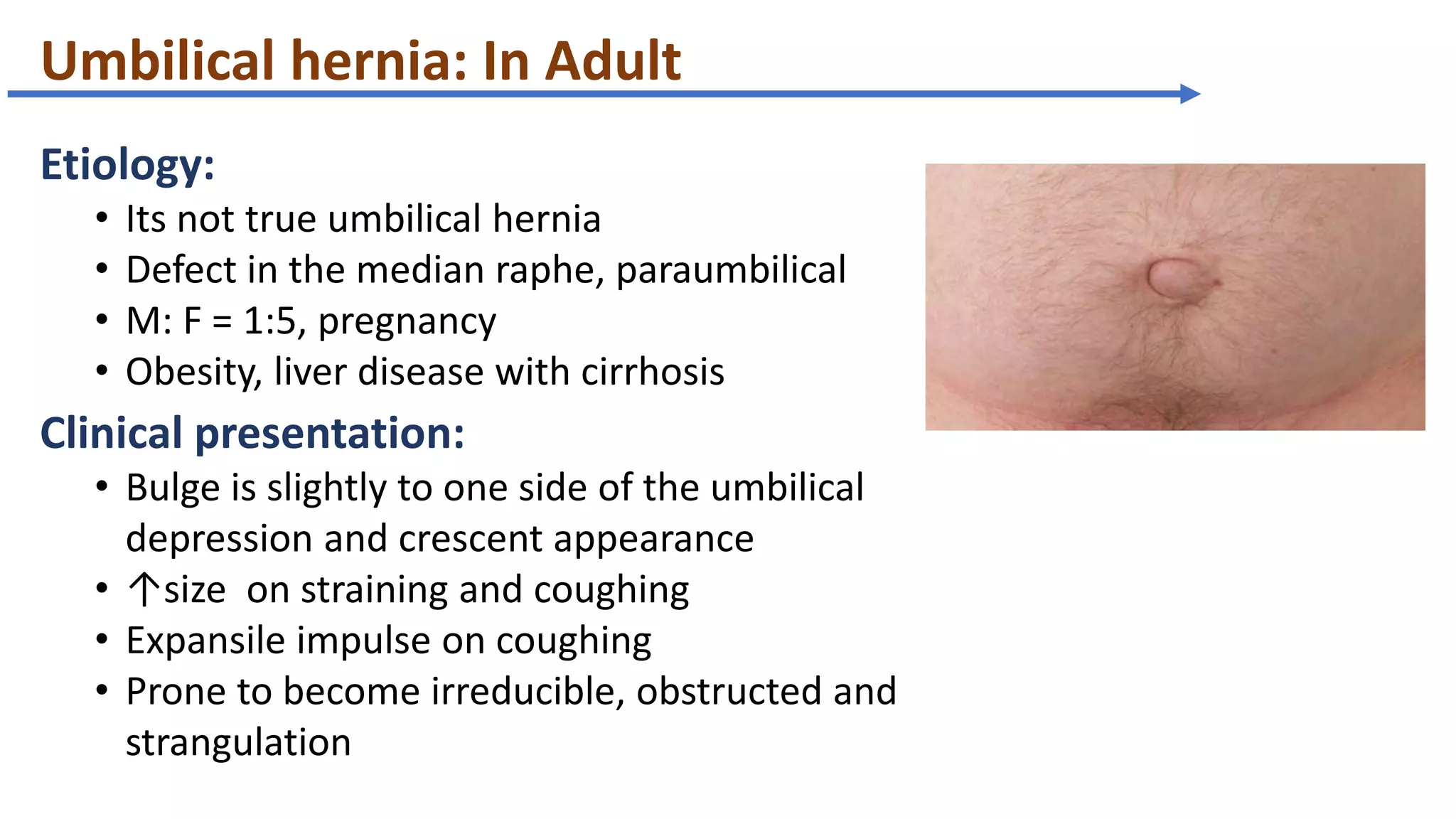 Femoral hernia with umbilical hernia | PPTX
