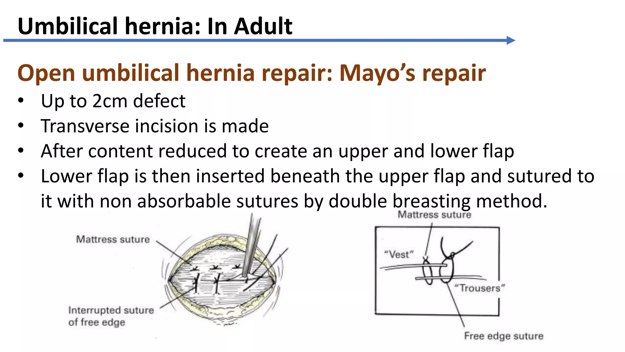 Femoral hernia with umbilical hernia | PPTX
