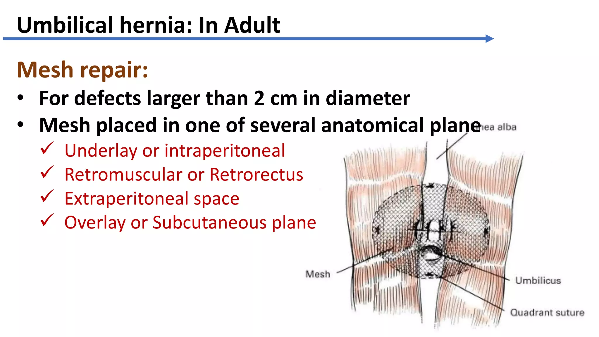 Femoral hernia with umbilical hernia | PPTX