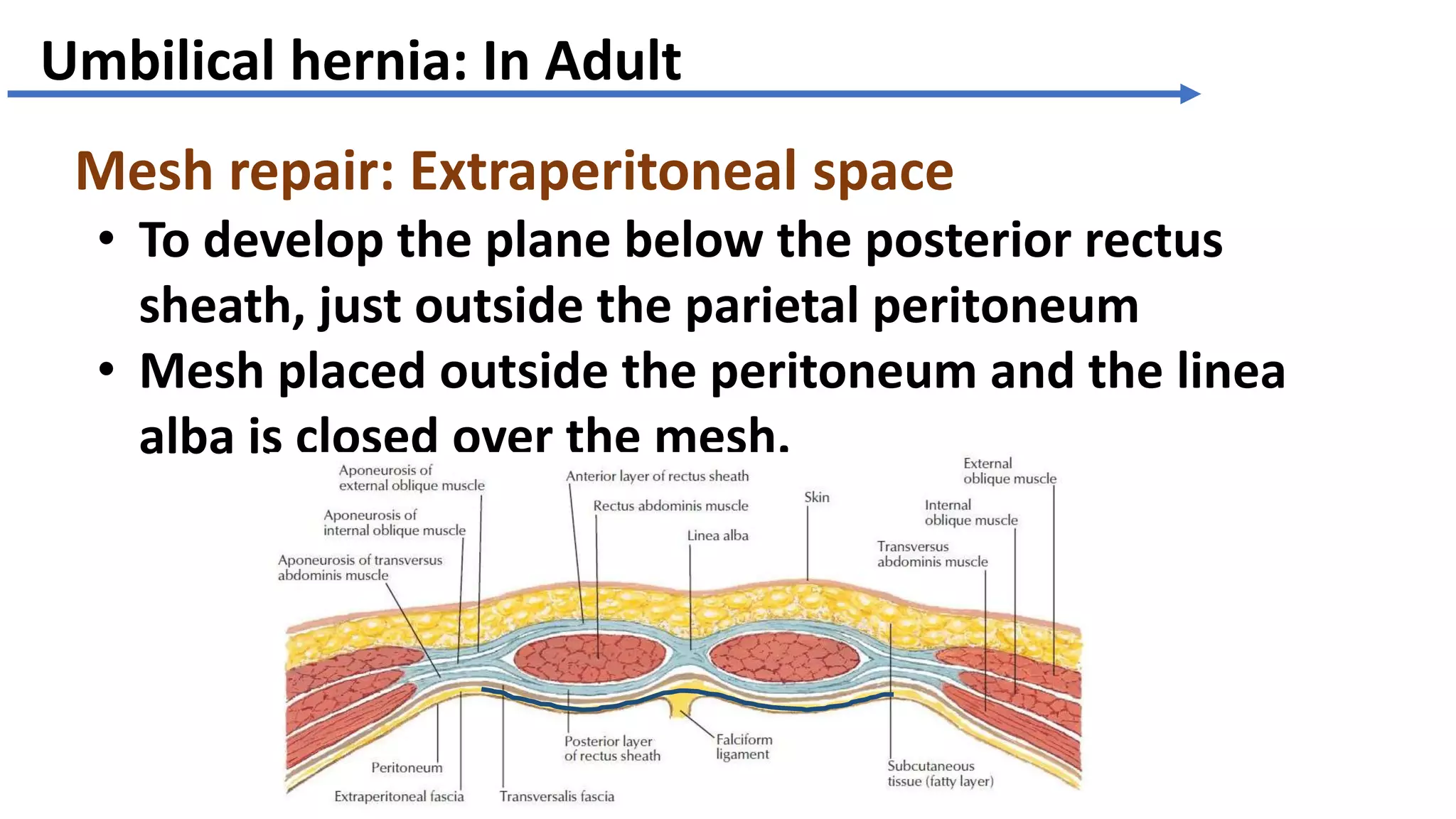 Femoral hernia with umbilical hernia | PPTX