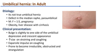 Femoral hernia with umbilical hernia | PPTX