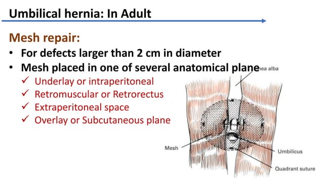 Femoral hernia with umbilical hernia | PPT