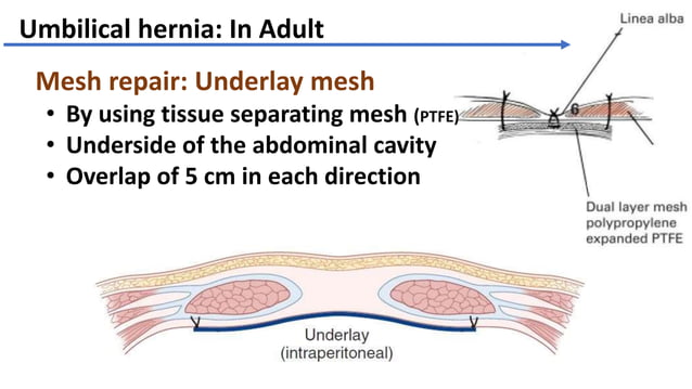 Femoral hernia with umbilical hernia | PPT