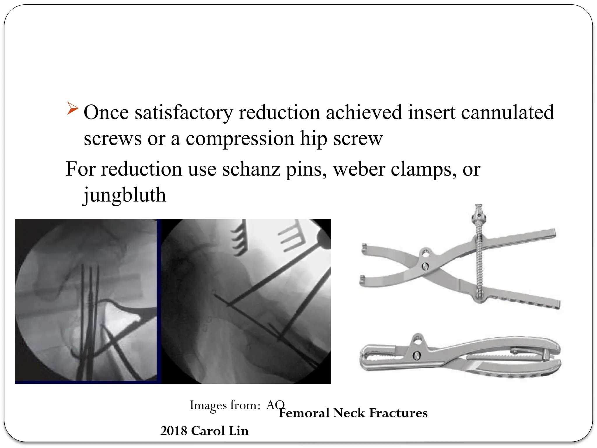 Femoral Neck fracture and it's Management | PPTX