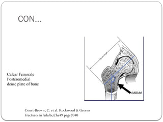 Femoral Neck fracture and it's Management | PPTX