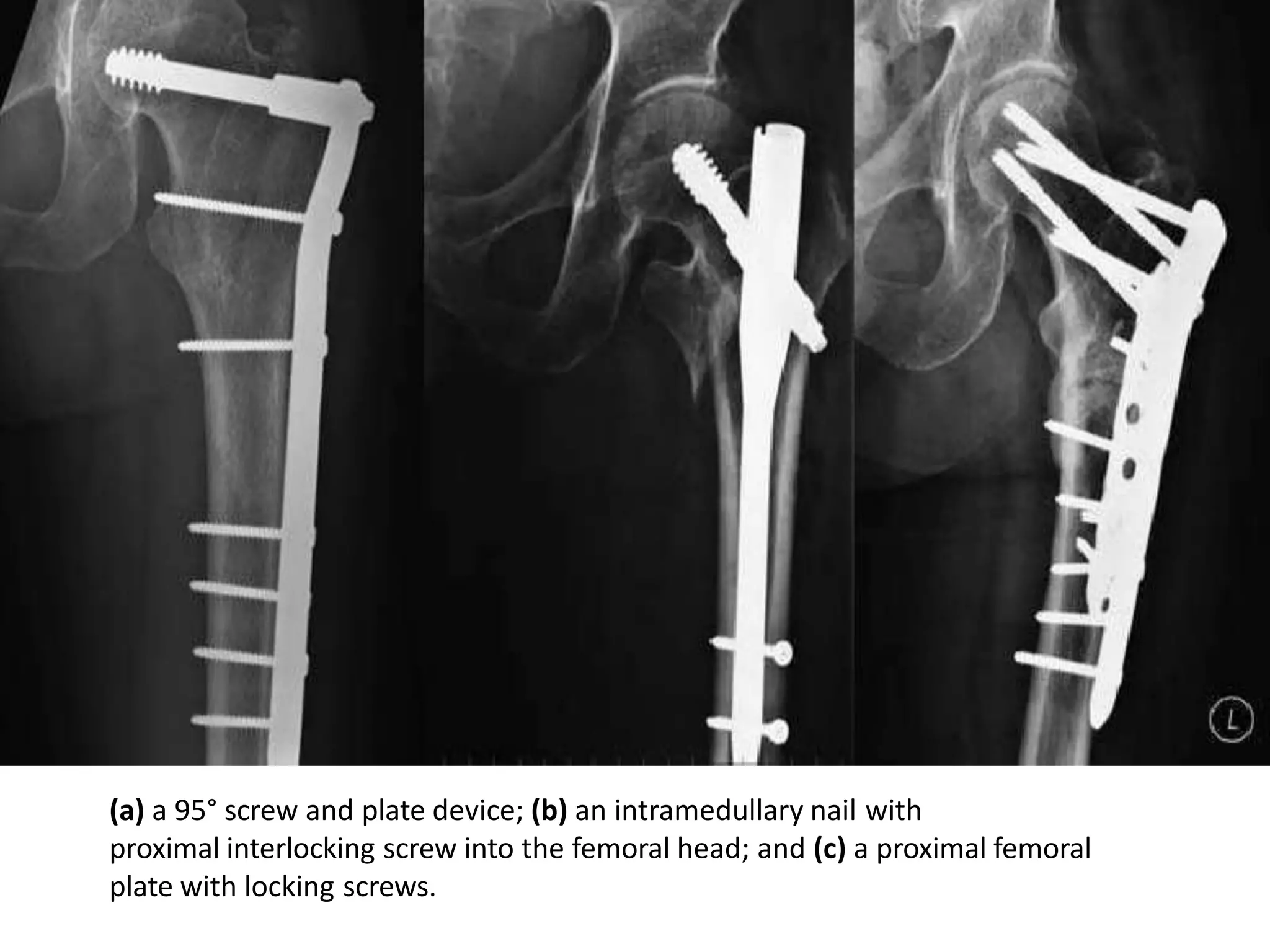 femoral neck fracture .pptx