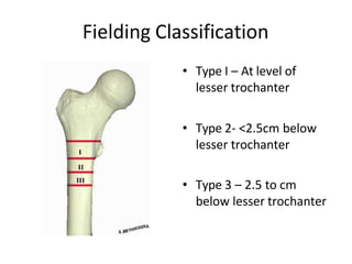 femoral neck fracture .pptx