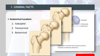 (Orthopedics) Femoral neck fractures (Anatomy, pathophysiology and ...