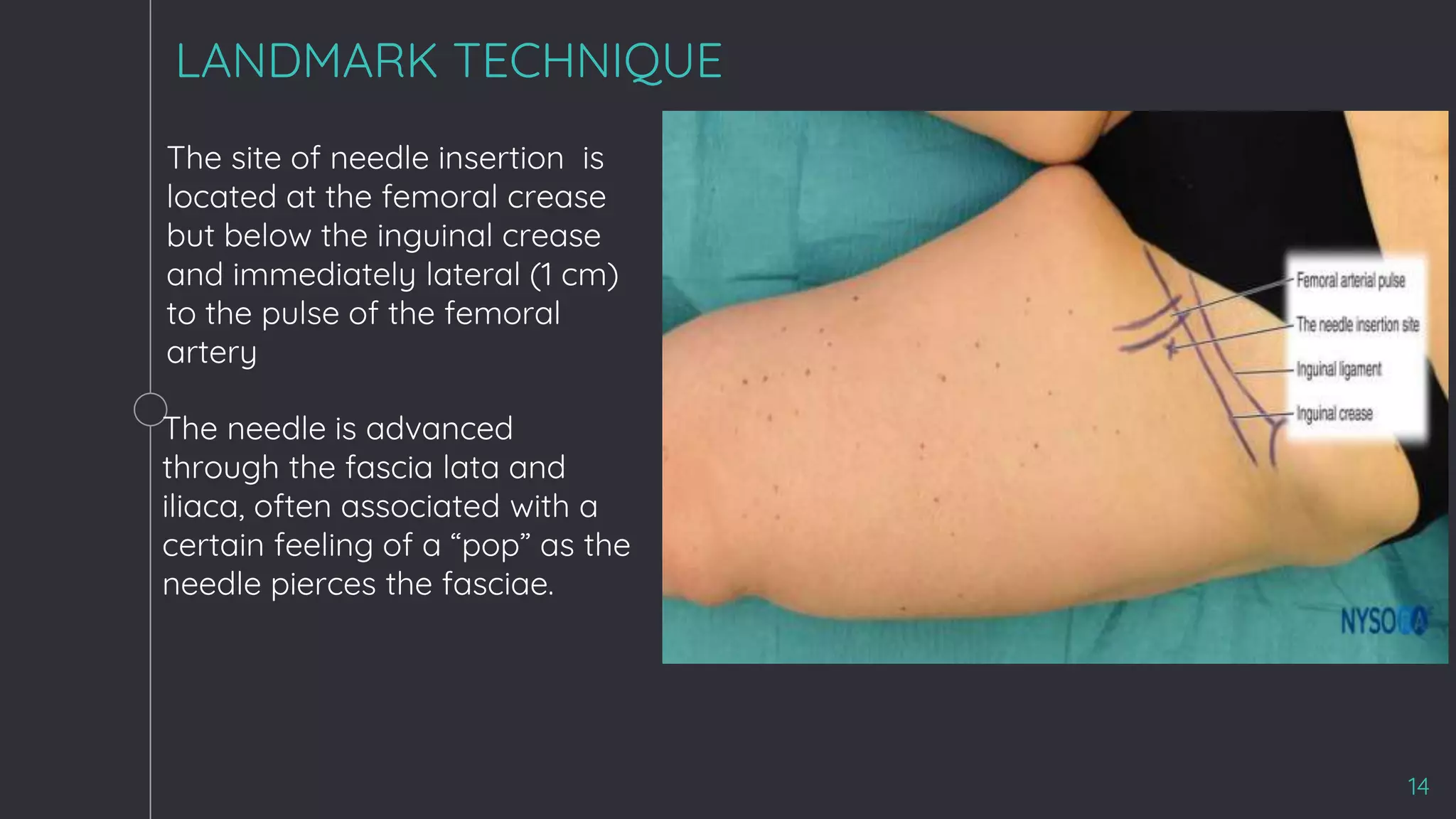 FEMORAL NERVE BLOCK'.pptx
