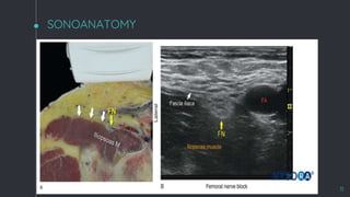 FEMORAL NERVE BLOCK'.pptx