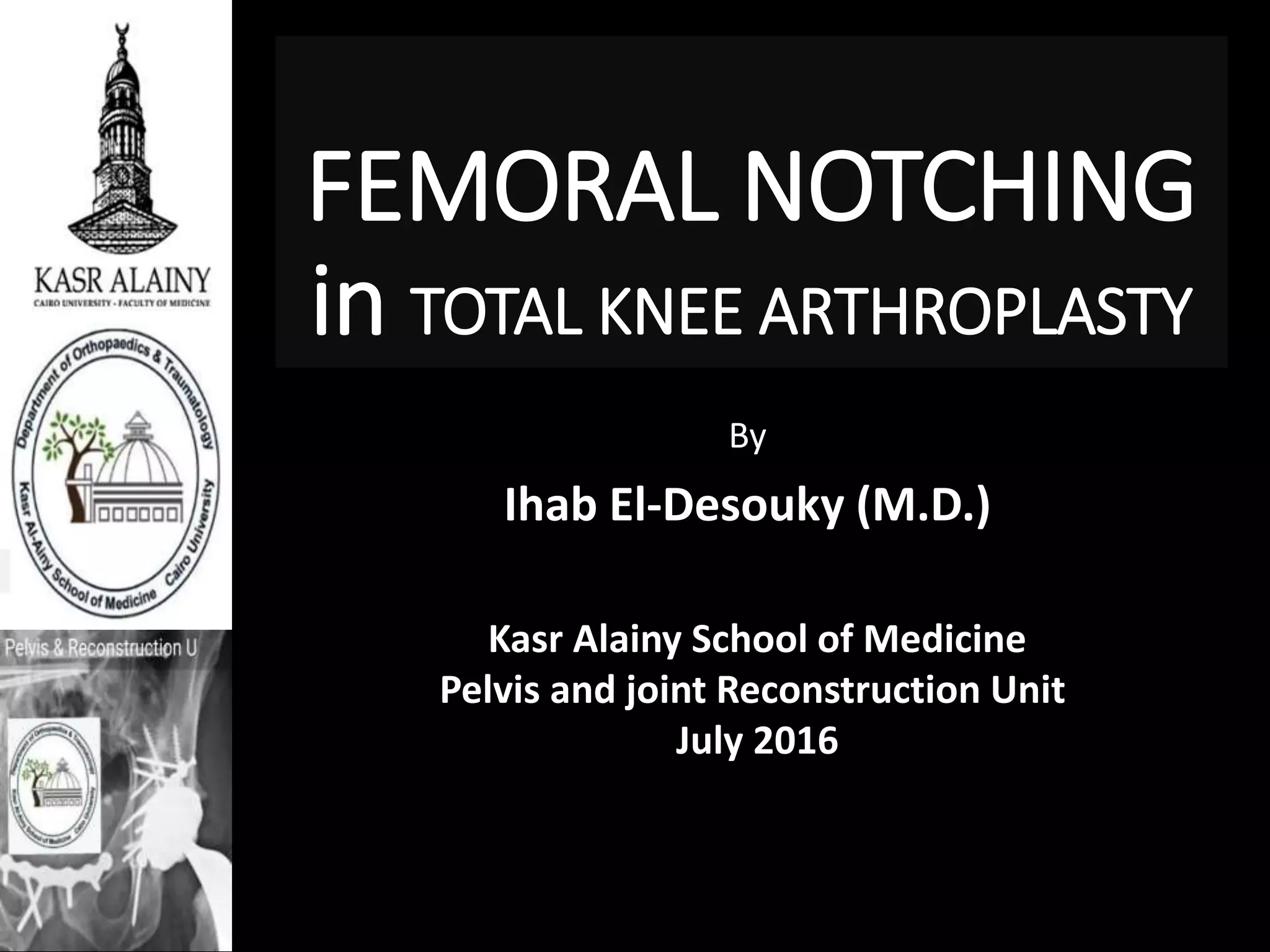 Femoral notching in total knee arthroplasty | PPTX