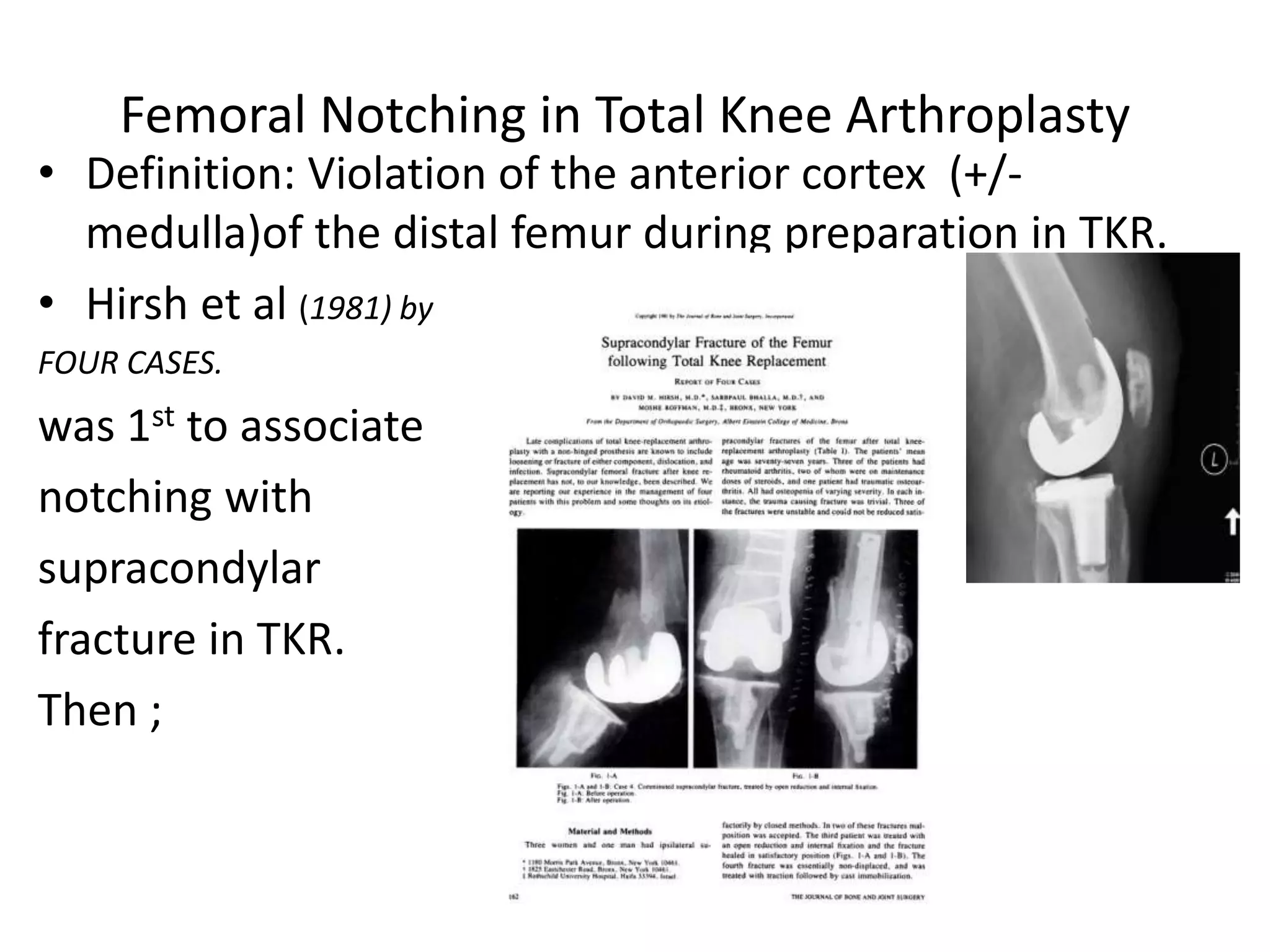 Femoral notching in total knee arthroplasty | PPTX