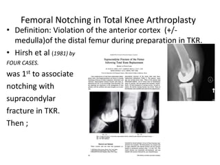 Femoral notching in total knee arthroplasty | PPTX