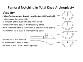 Femoral notching in total knee arthroplasty | PPTX