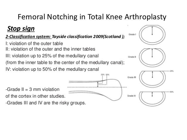 Femoral notching in total knee arthroplasty