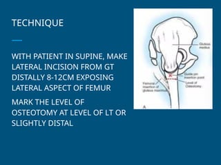 FEMORAL OSTEOTOMIES : SCHANZ, PAUWELS, MCMURRAY | PPTX