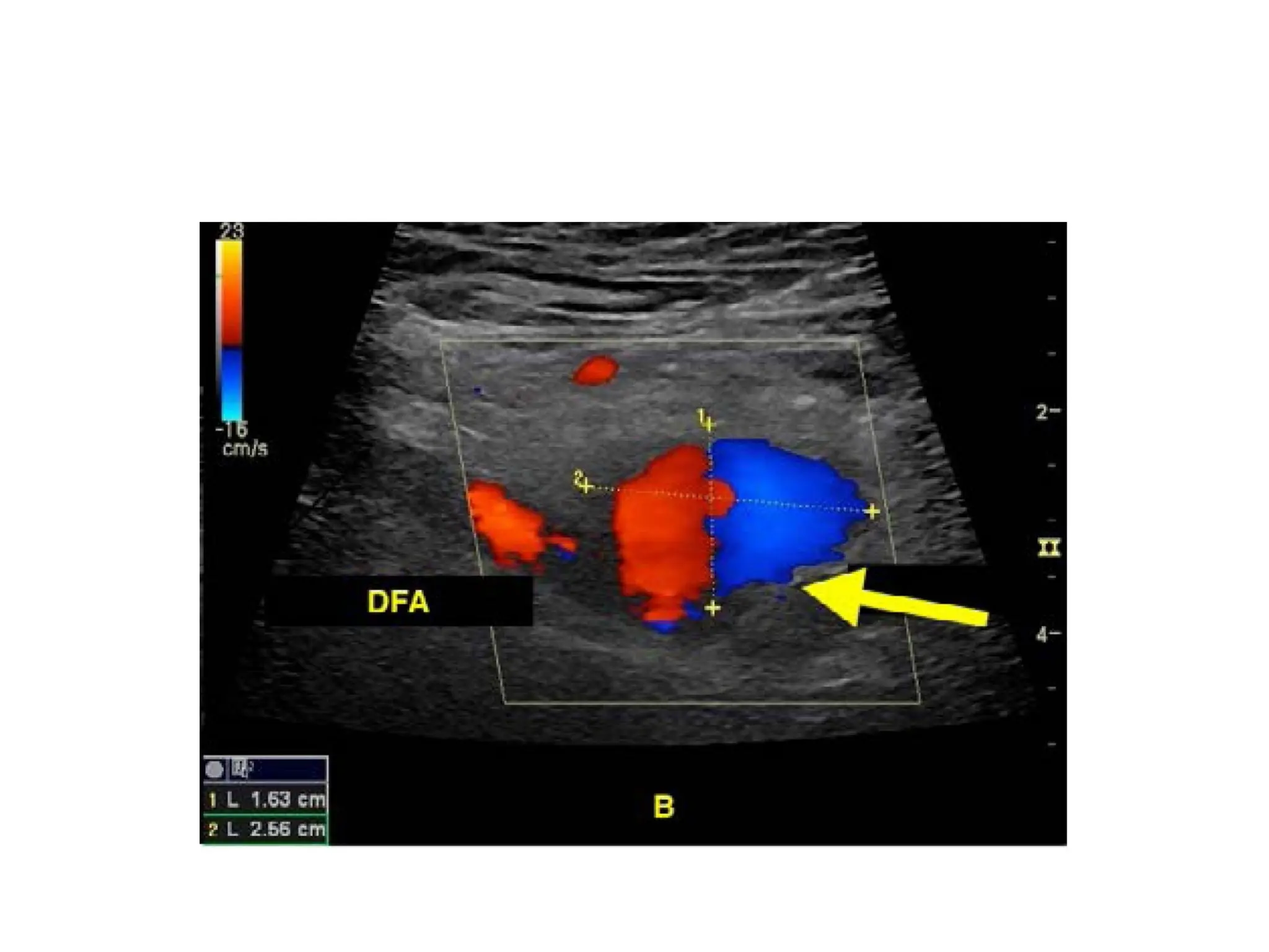 FEMORAL PSEUDOANEURYSM IN IVDUs tips and tricks.pptx