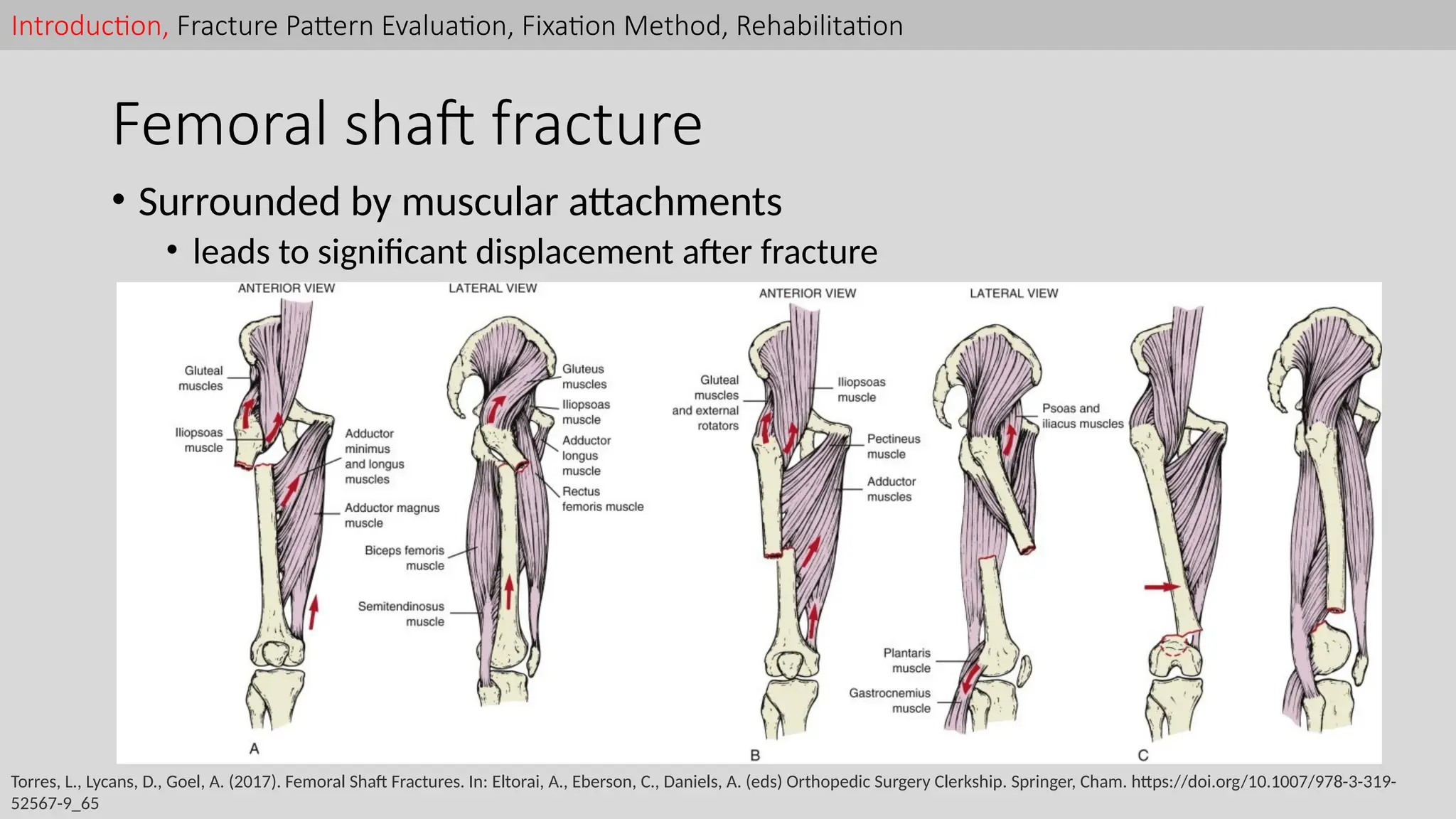 Femoral_Shaft_Fracture at the thigh.pptx