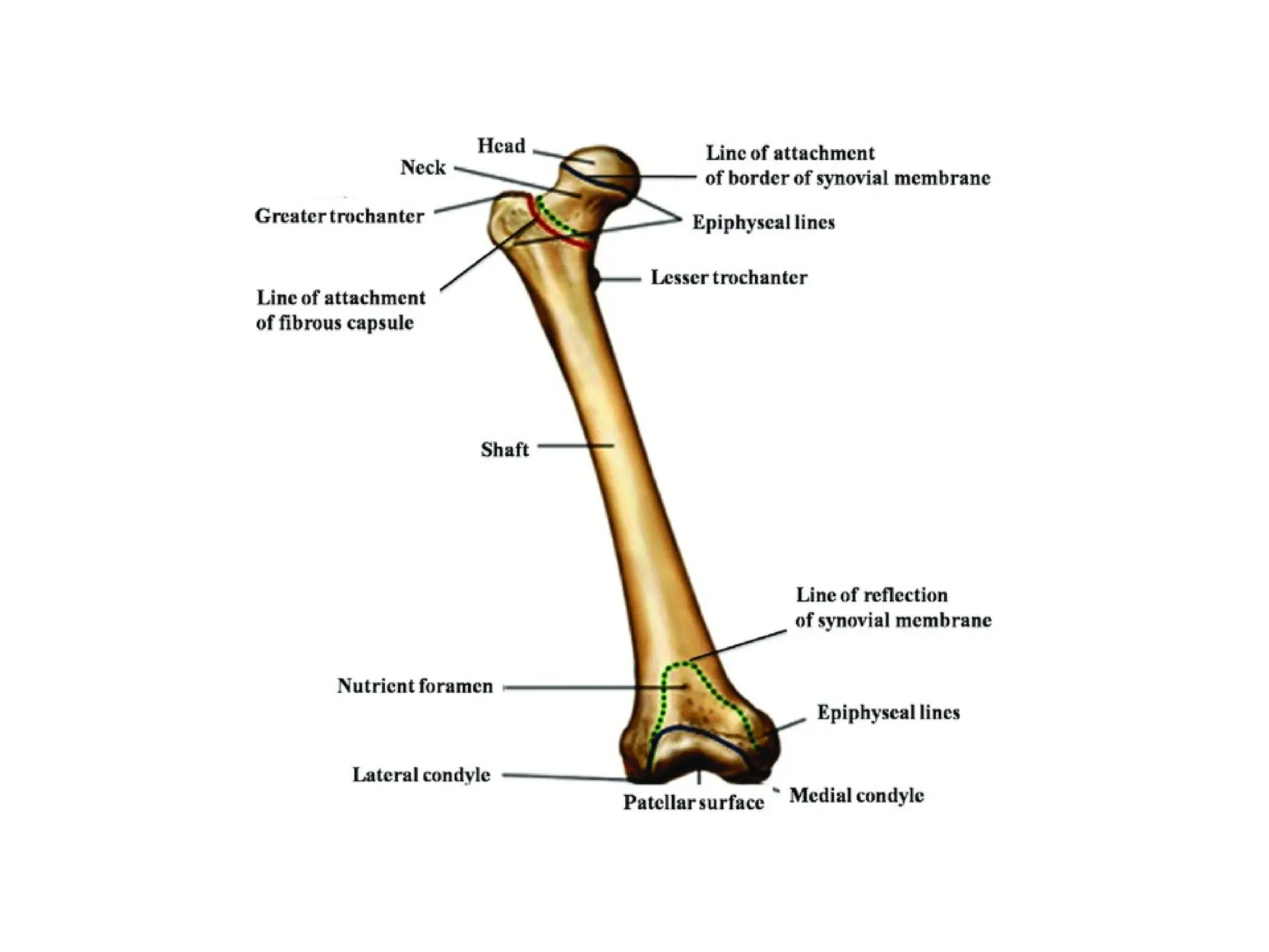 most common FEMORAL SHAFT FRACTUres.pptx