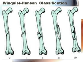 Femoral shaft fractures | PPTX
