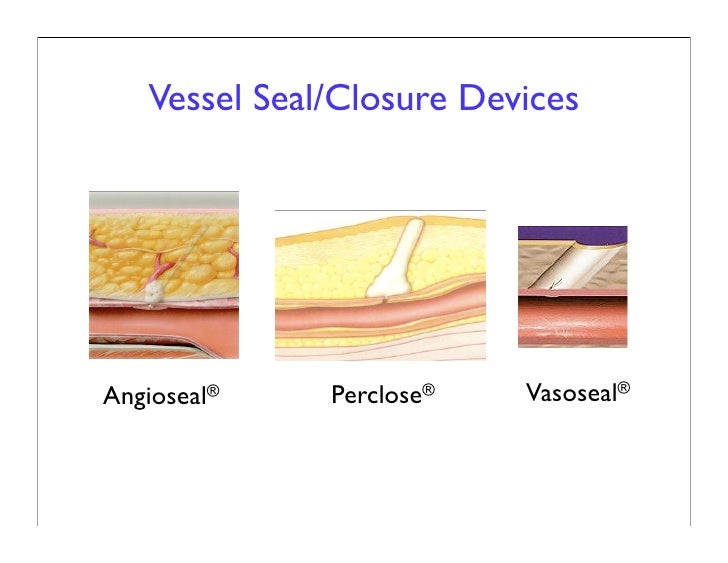 Femoral Site Complications