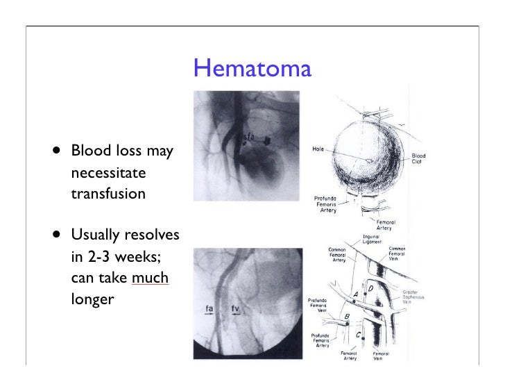 Femoral Site Complications
