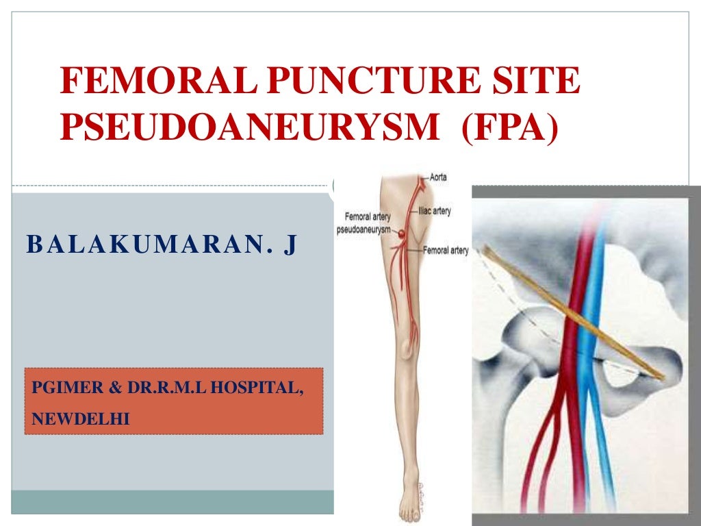 Femoral site psudeoaneurysm